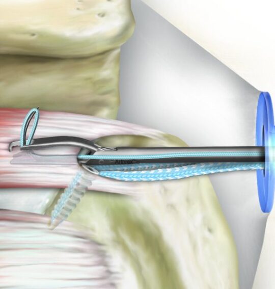 Arthroscopic rotator cuff repair - Glasgow Shoulder Clinic
